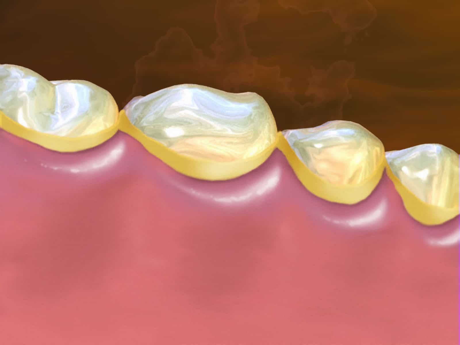 Cinque rimedi contro la placca dentale